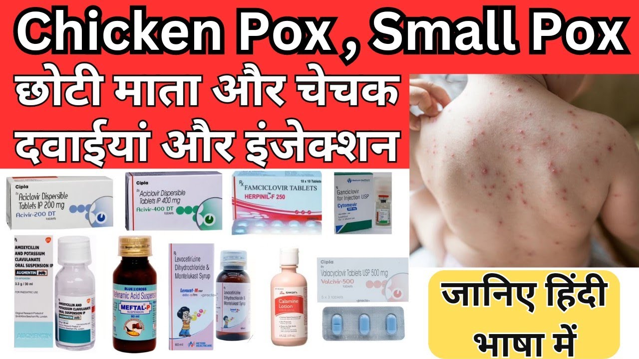Chicken Pox Small Pox | छोटी माता और चेचक की दवाईयां और इंजेक्शन सबको ...