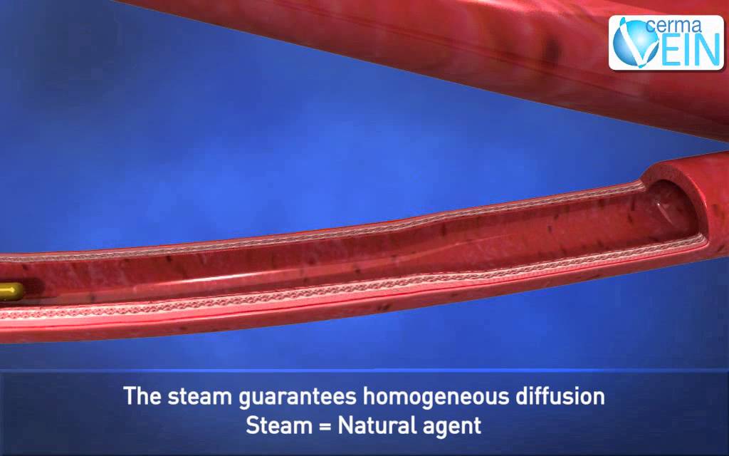 VenoSteam - THE global solution for endovenous treatment - FlexiVein ...