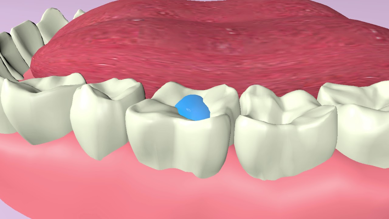 Teeth decay 3D Animation - YouTube