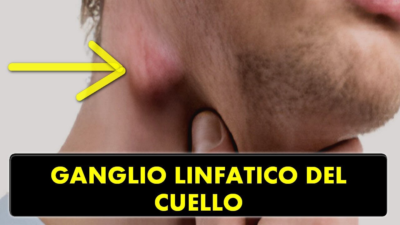 CRECIMIENTO DE GANGLIOS LINFÁTICOS EN LA REGIÓN DEL CUELLO: ¿CAUSAS Y ...