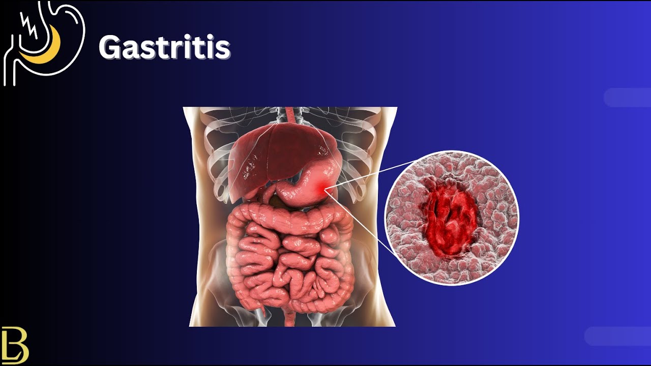 Gastritis - Acute gastritis / Chronic gastritis / Atrophic Autoimmune ...