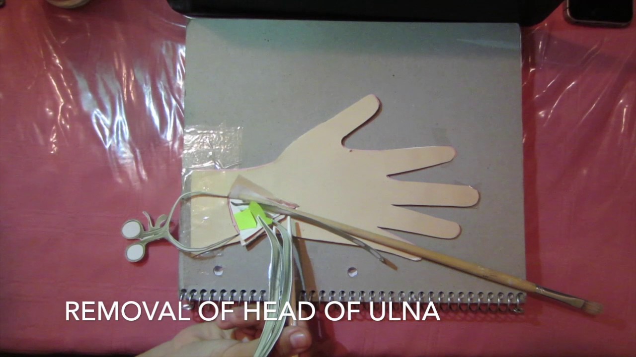 The Darrach Procedure in Under a Minute - YouTube