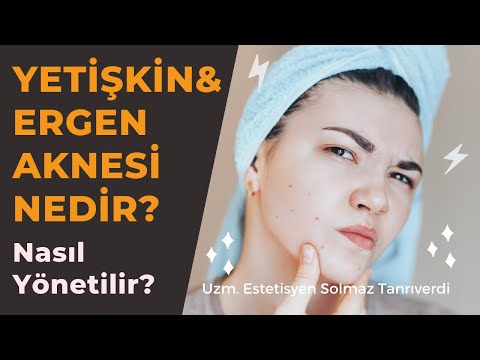 Akne Nedir? Akneleri Gidermede Neler Yapılabilir? | pHformula | Uzm. Estetisyen Solmaz Tanrıverdi