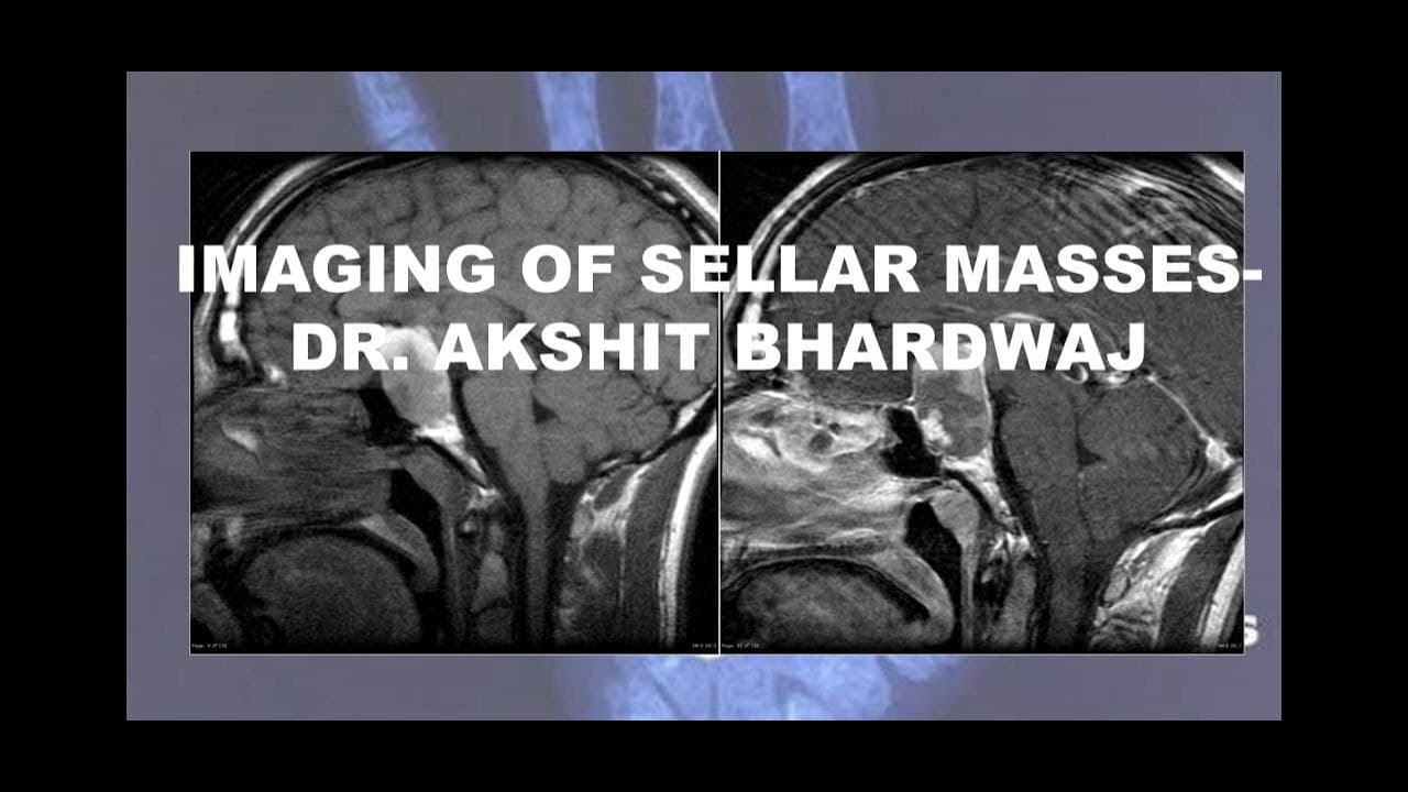 IMAGING OF SELLAR MASSES - PART 1 II DR. AKSHIT II RADIOLOGY LECTURES ...