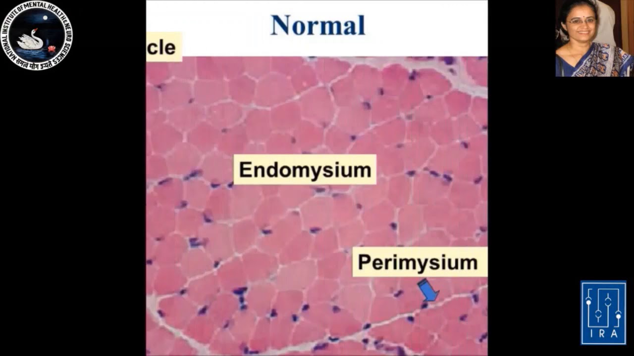 What A Clinician Needs to Know? Essentials of Muscle Biopsy ...