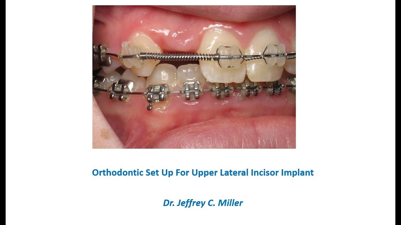 Orthodontic Set Up For Upper Lateral Incisor Implant - YouTube