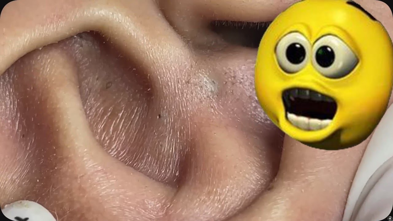 ∑00090 ♂ = Extraction&Removal = Ears - YouTube