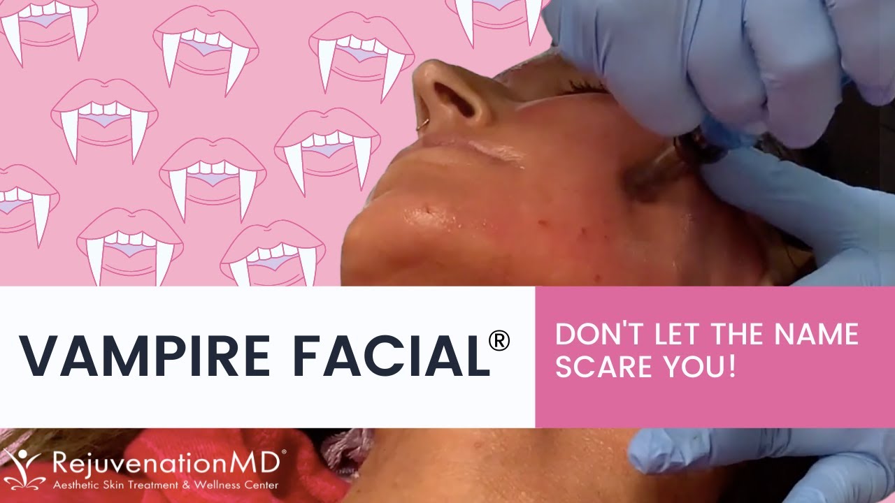 Vampire Facial Procedure: Platelet Rich Plasma Facial Used by Hollywood ...