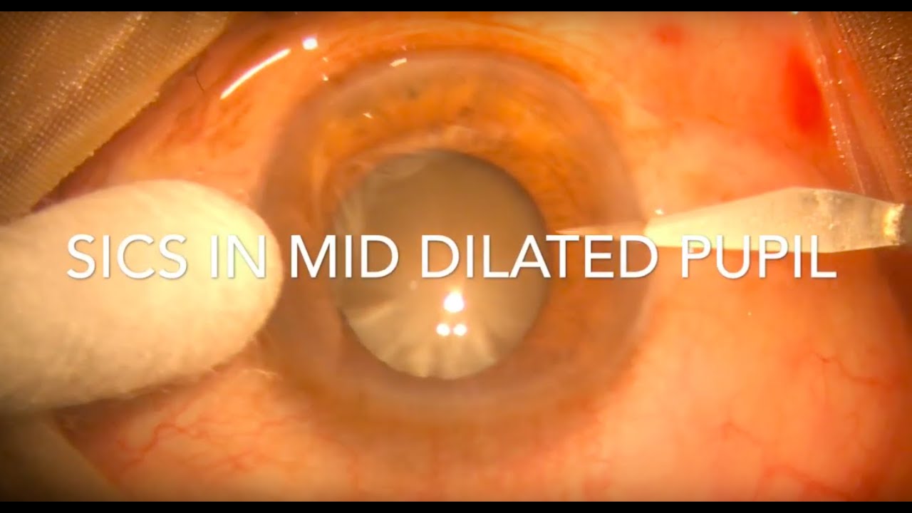 #11 SICS Mid Dilated Pupil N Much More - YouTube