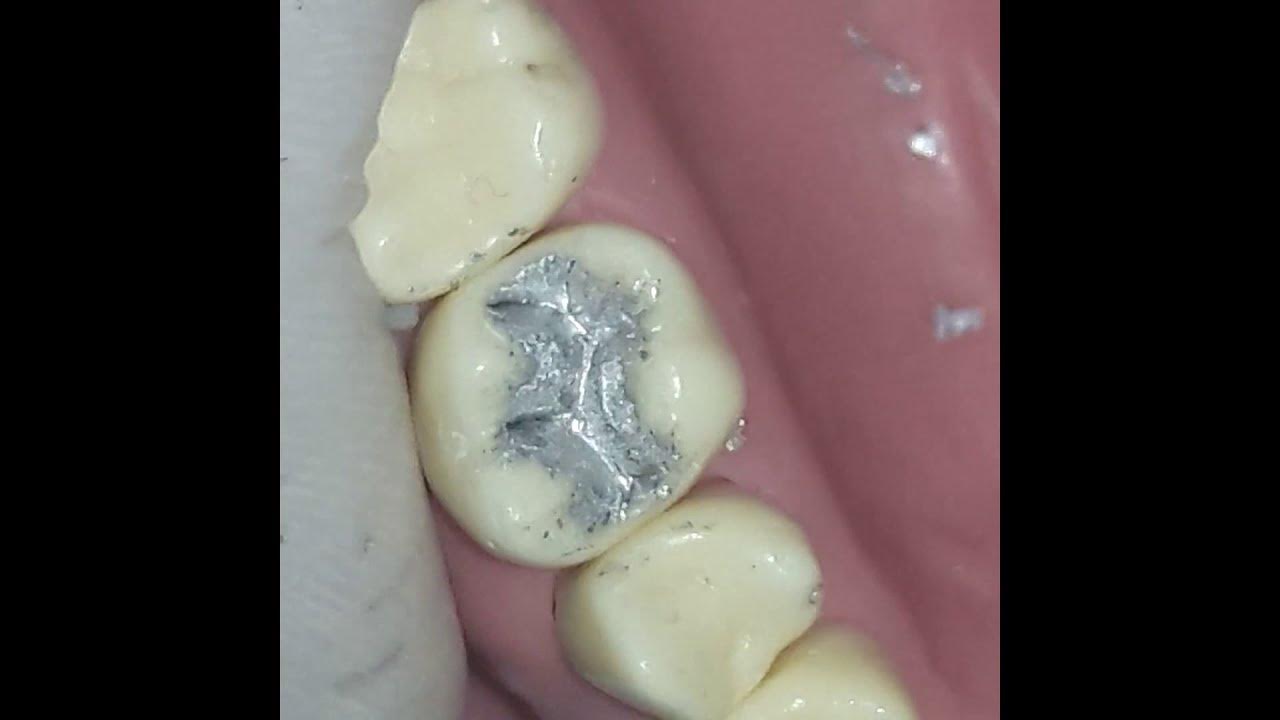 Class I Amalgam Restoration - YouTube