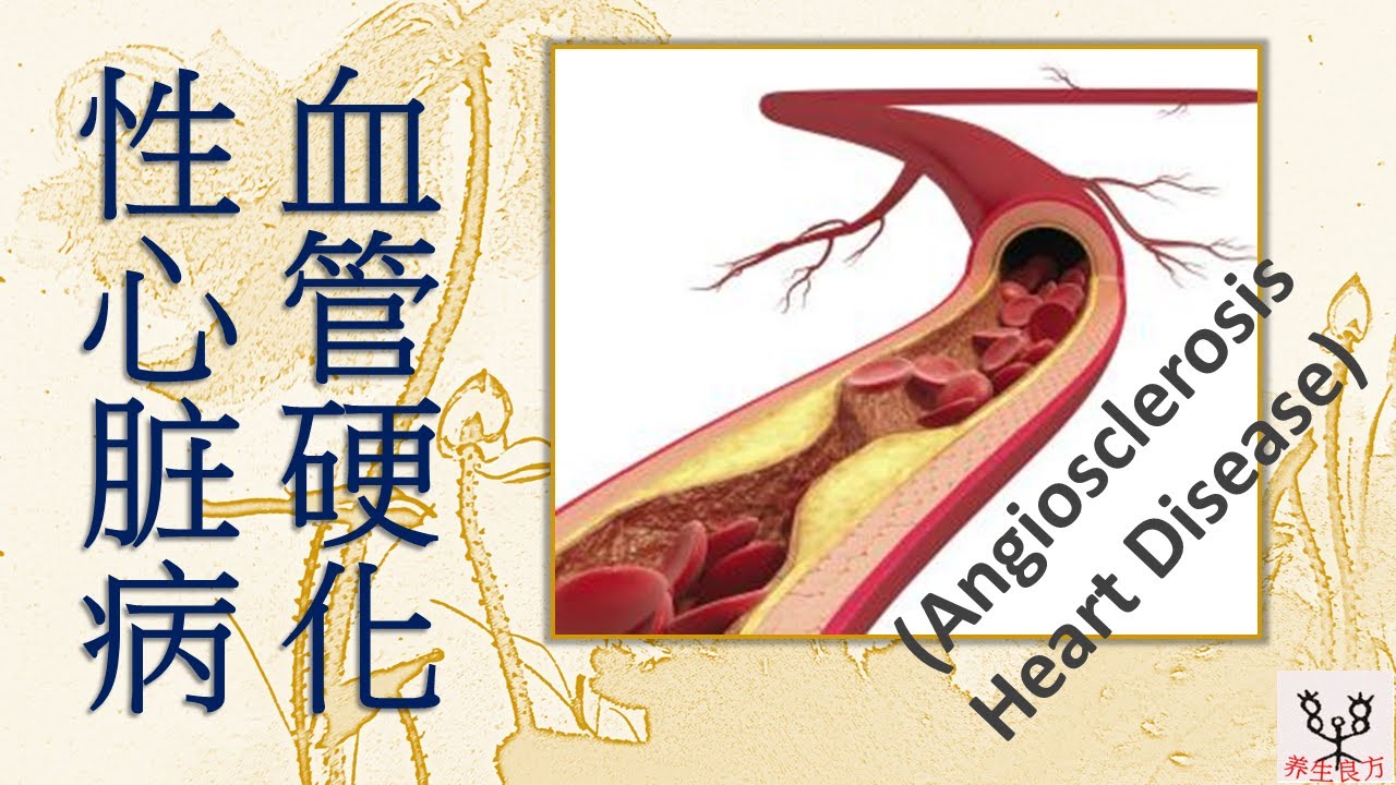 血管硬化性心脏病 Angiosclerosis Heart Disease - YouTube