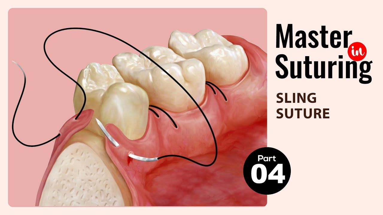Sling Suture - Periodontal Suturing Technique - YouTube
