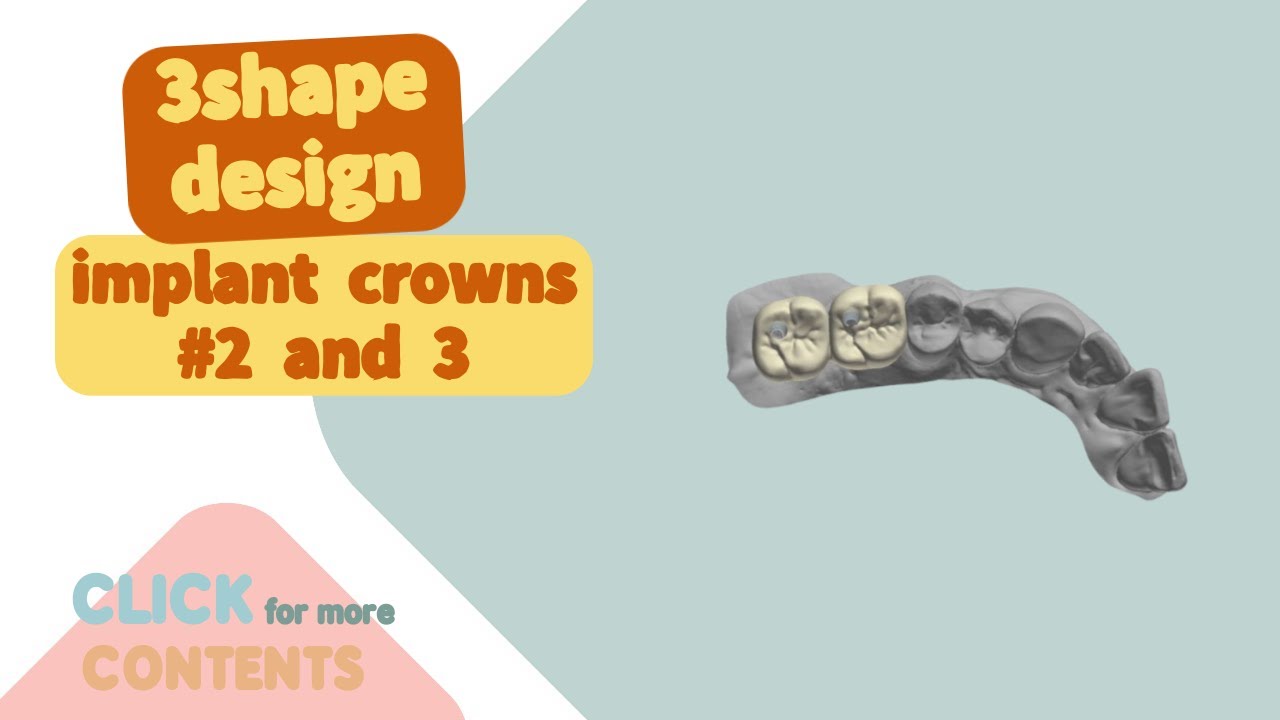 3shape design implant crowns #2 and 3 - YouTube