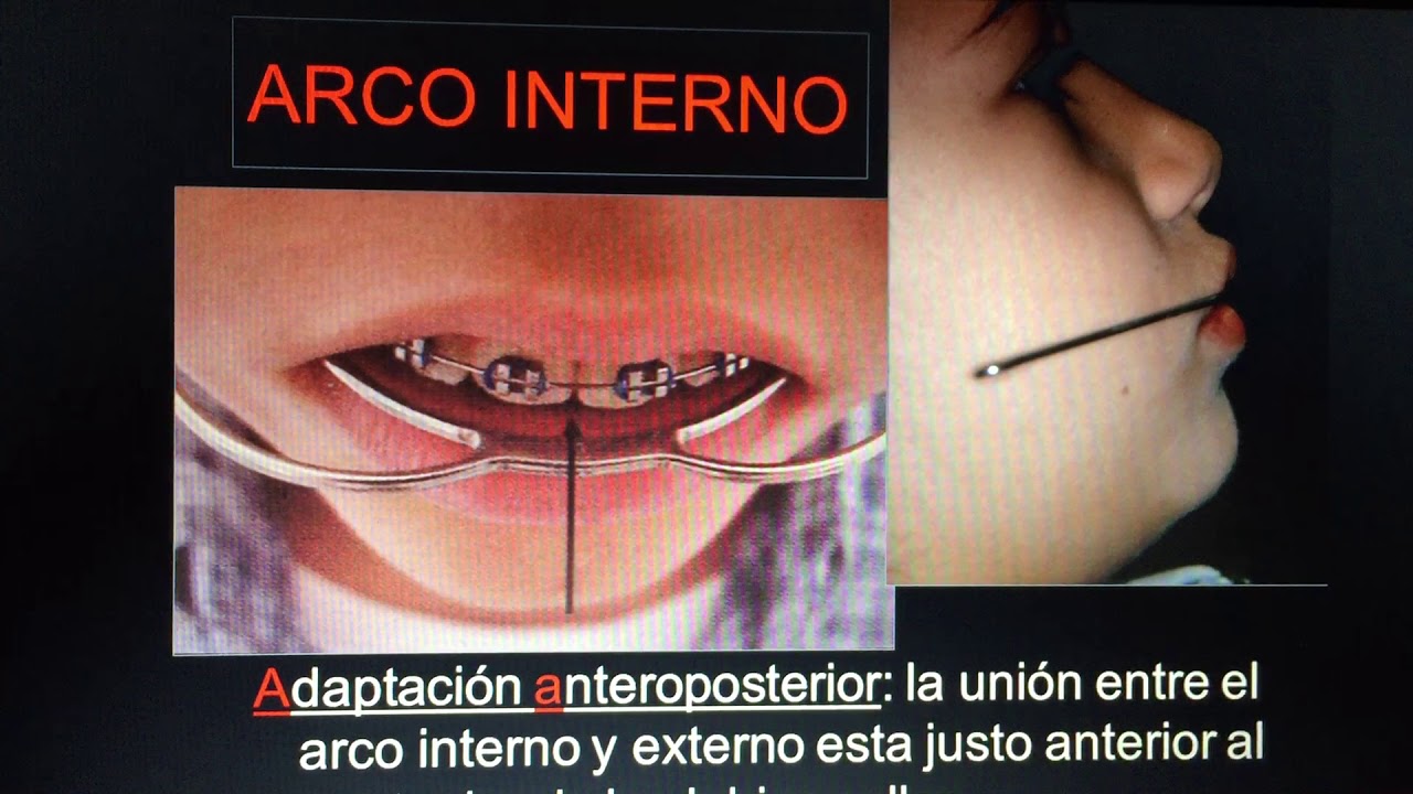 VIDEO INSTALACION TRACCION EXTRAORAL - YouTube