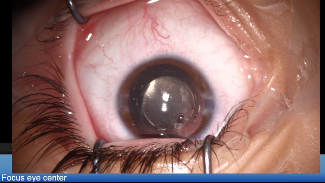 Pediatric cataract , posterior capsulo rhexis, reversed optic B+L MX60 ...