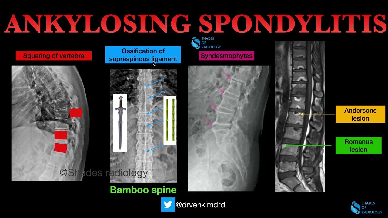Ankylosing Spondylitis- Classic Imaging features - YouTube