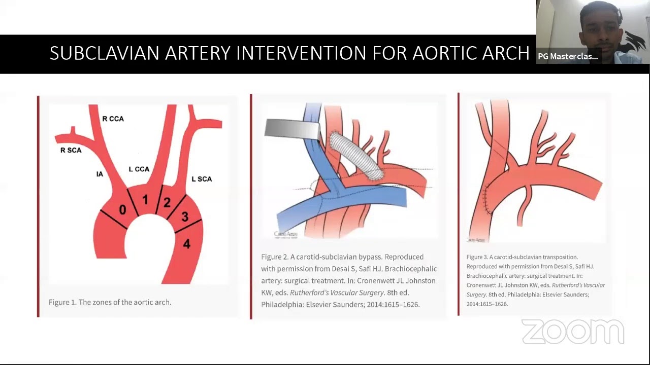 Seminar on A surgical approach to thoracic outlet and subclavian ...