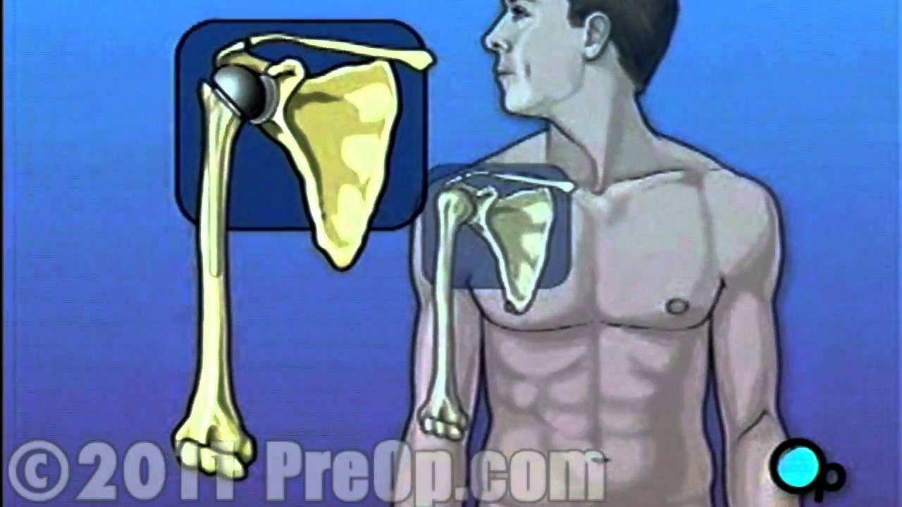 Shoulder Replacement Surgery PreOp® Patient Education HD - YouTube