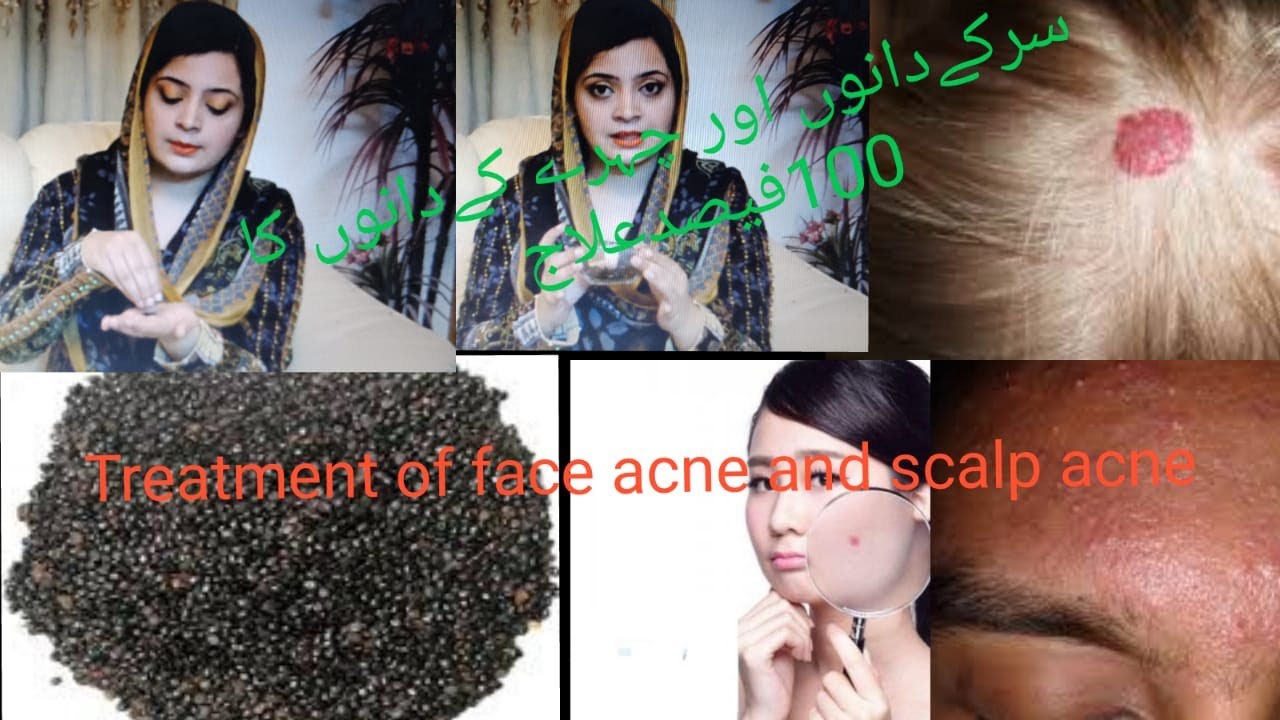 summer acne treatment | just 1 Ingredient with affordable price | use ...