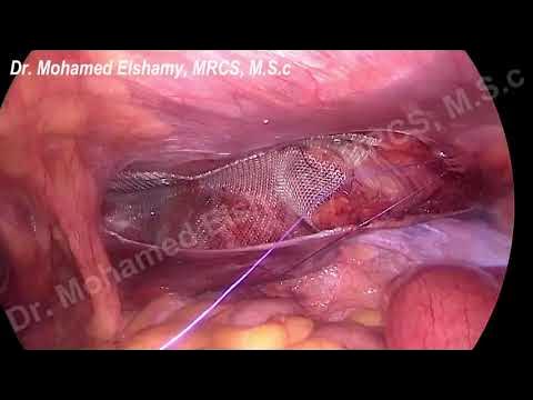 Laparoscopic Inguinal Hernia Surgery | TAPP (Transabdominal Preperitoneal) Technique - YouTube