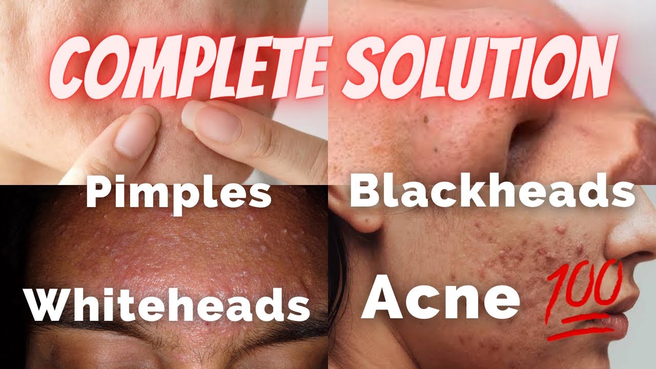 How To Treat Blackheads, Whiteheads And Clogged Pores | Benefits Of ...