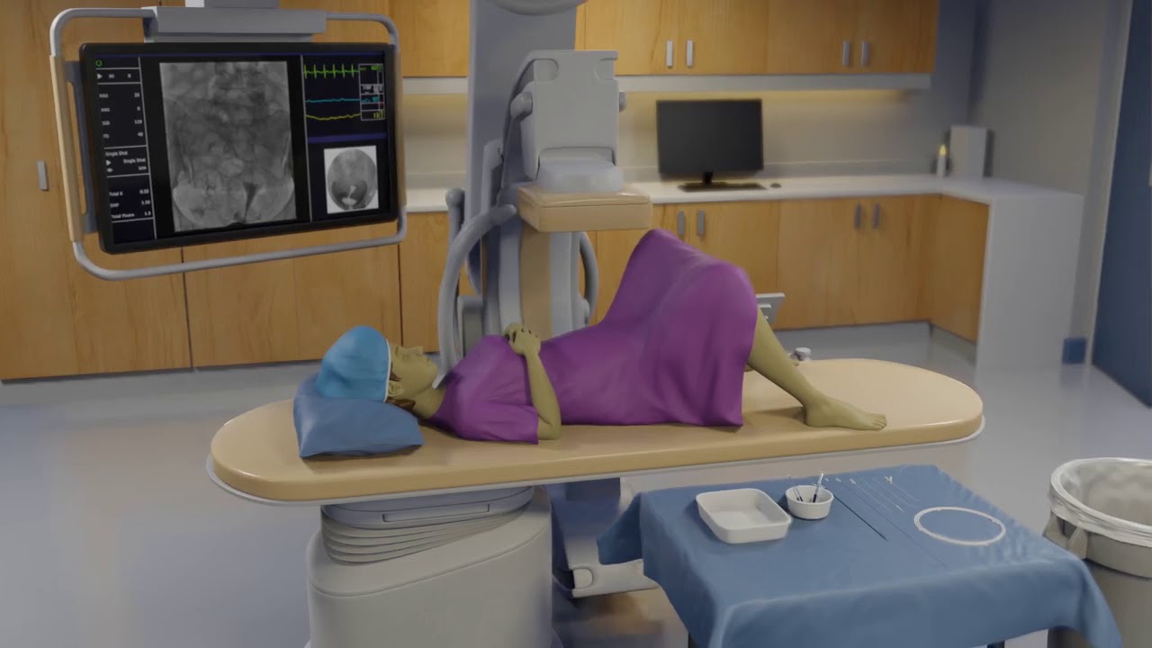 Fallopian tube recanalization - YouTube