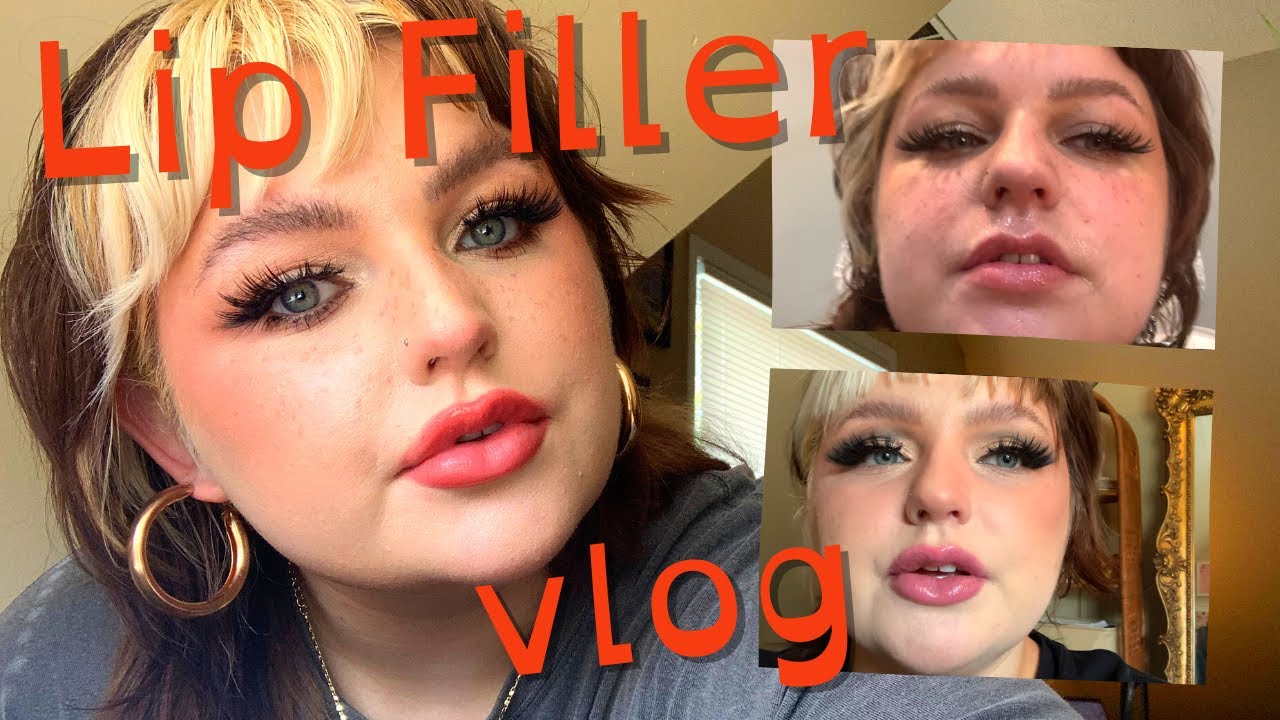 LIP FILLER VLOG | before and after with results and fully healed - YouTube