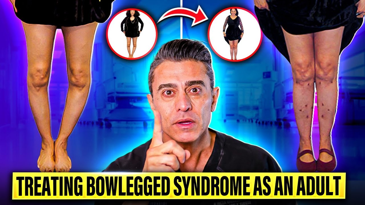 Overcoming Bowlegged Syndrome: A Step-by-Step Guide - YouTube