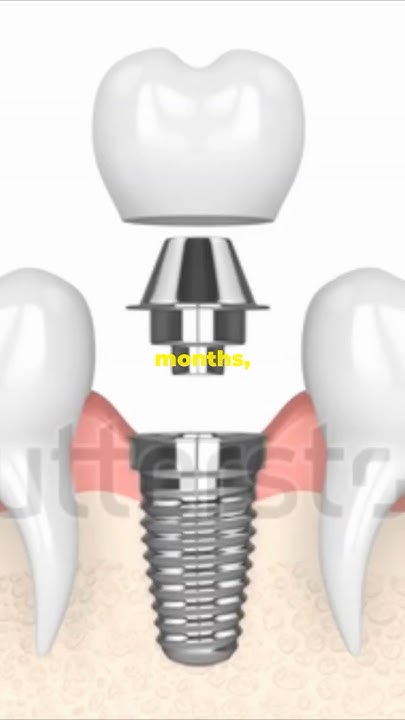 I Got Dental Implants - My Recovery Experience - YouTube