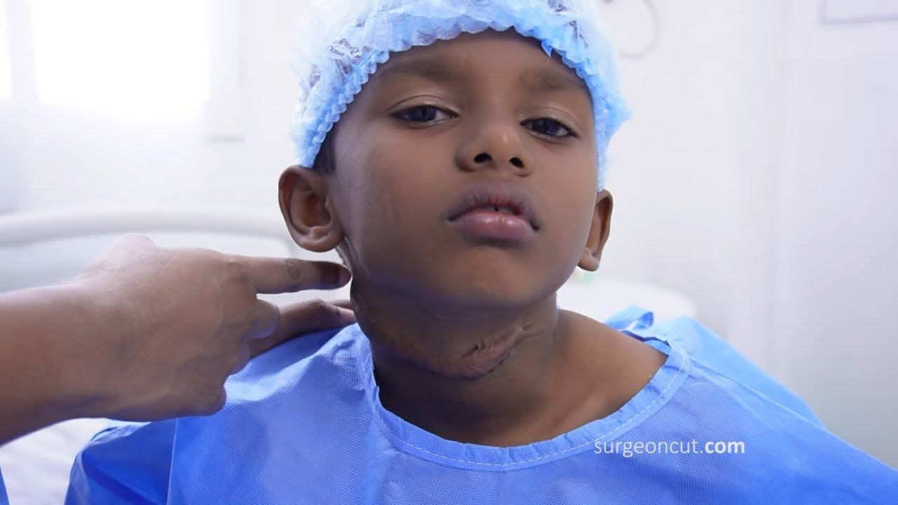 Big Scar on Neck Removed by Dr. Richardson | Scar Revision Surgery ...