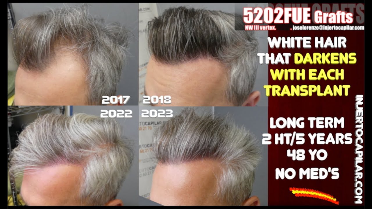 5202grafts. III V. White hair turn darker. Coverage reinforcement ...