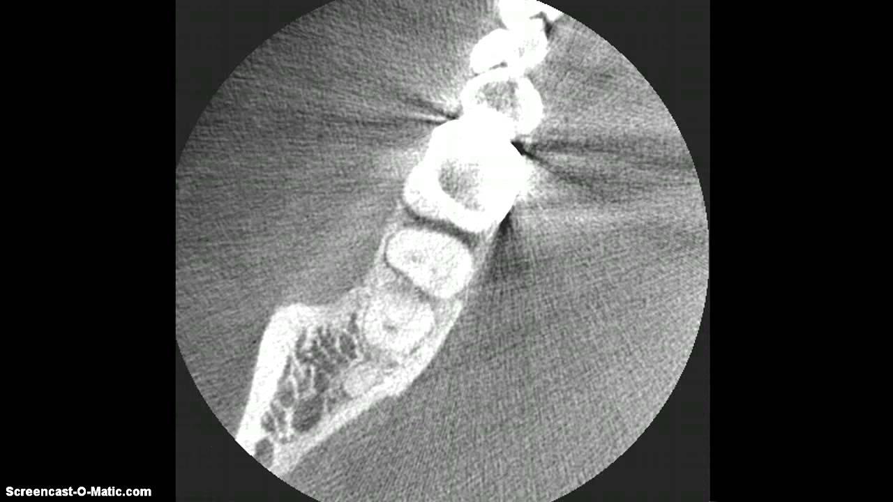 Dente 46 com 4 canais ENDODONTIA HD - YouTube