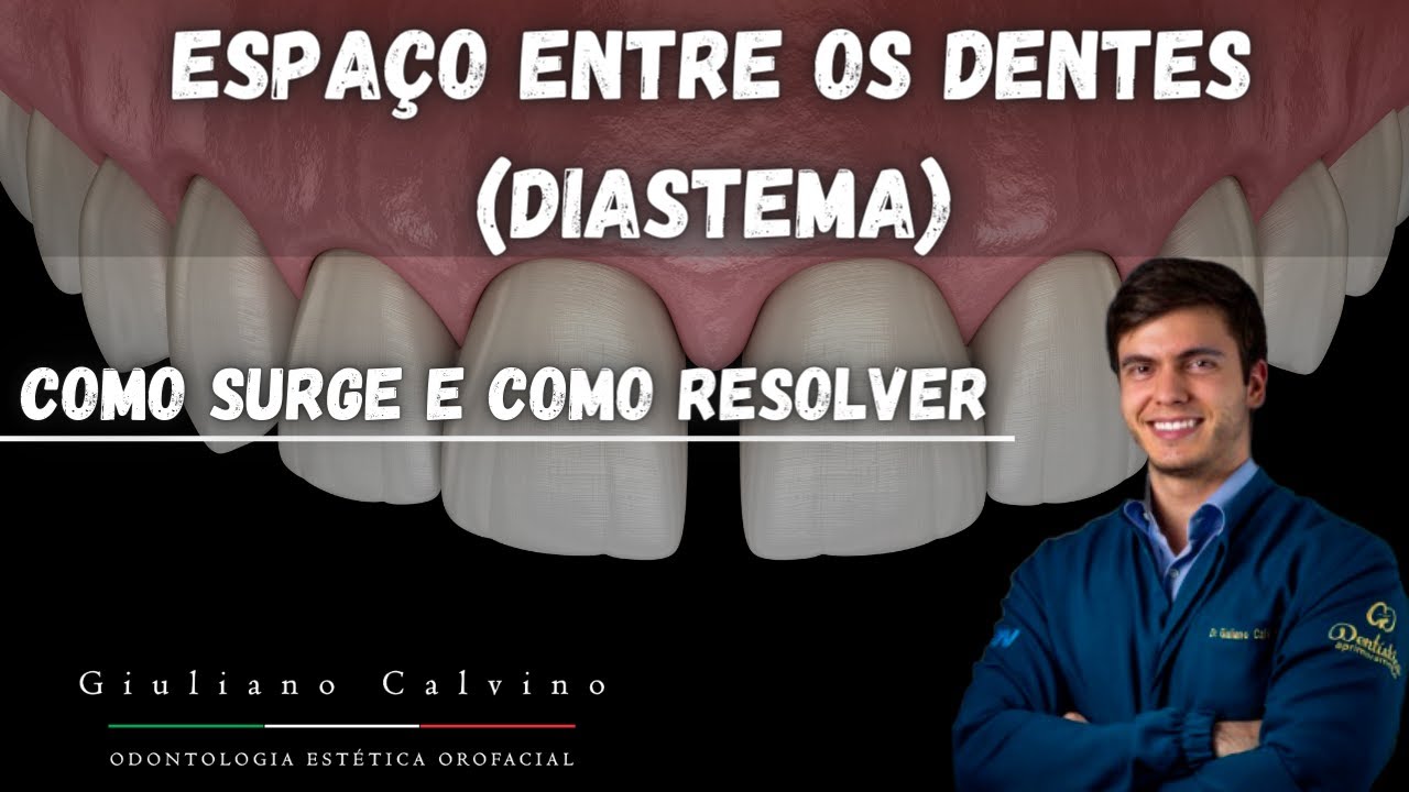 FECHAMENTO DE DIASTEMA (espaço entre os dentes) como surgem e como ...