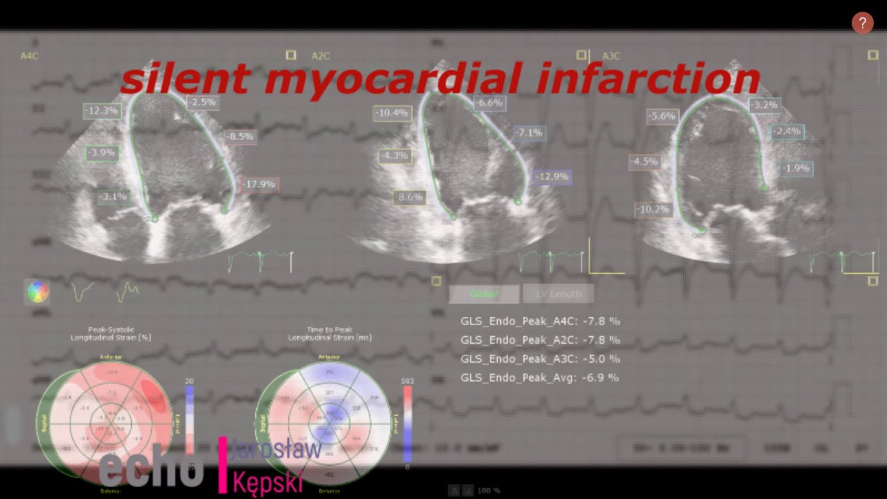 GLS -7% global longitudinal strain, LVEF 37%, silent myocardial ...
