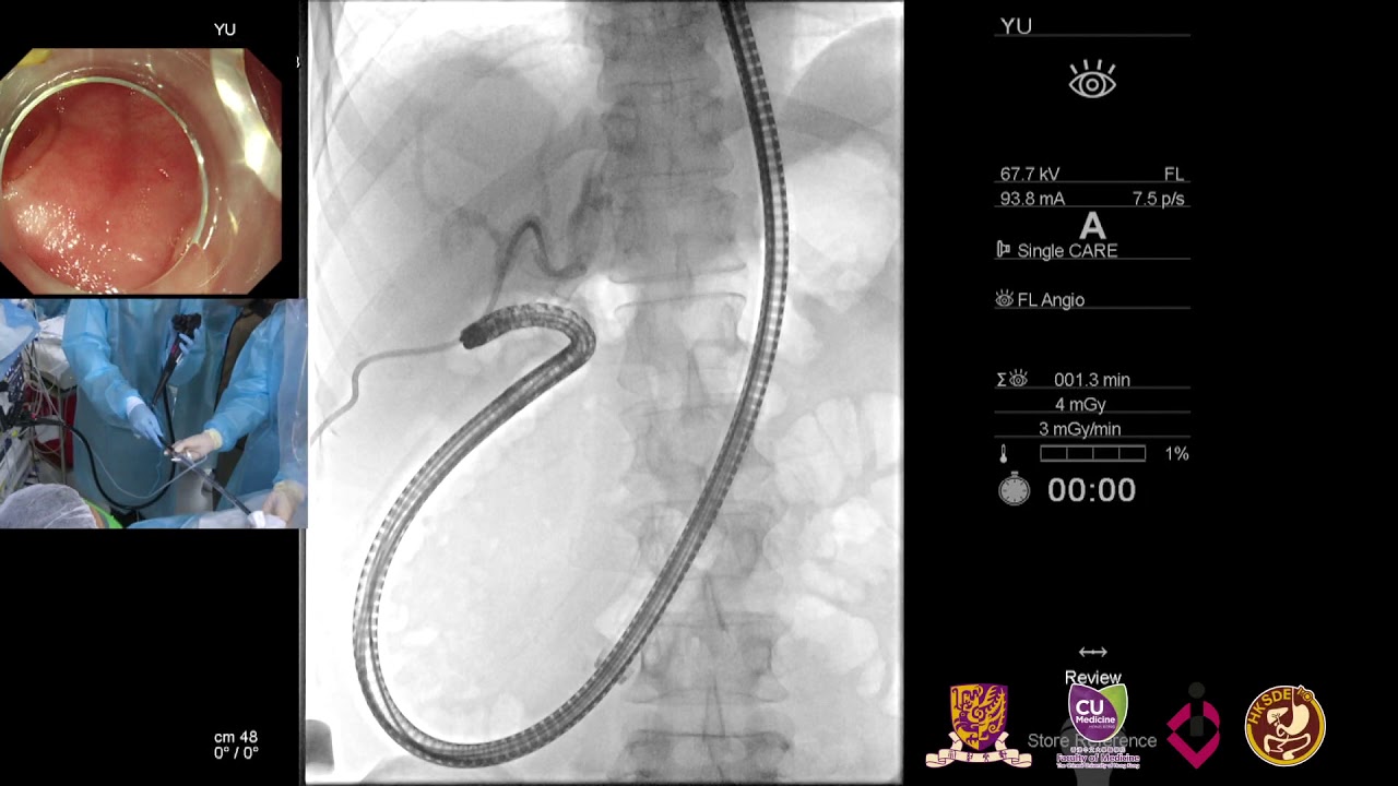 Case 15_Ballon enteroscopy assisted endoscopic retrograde ...