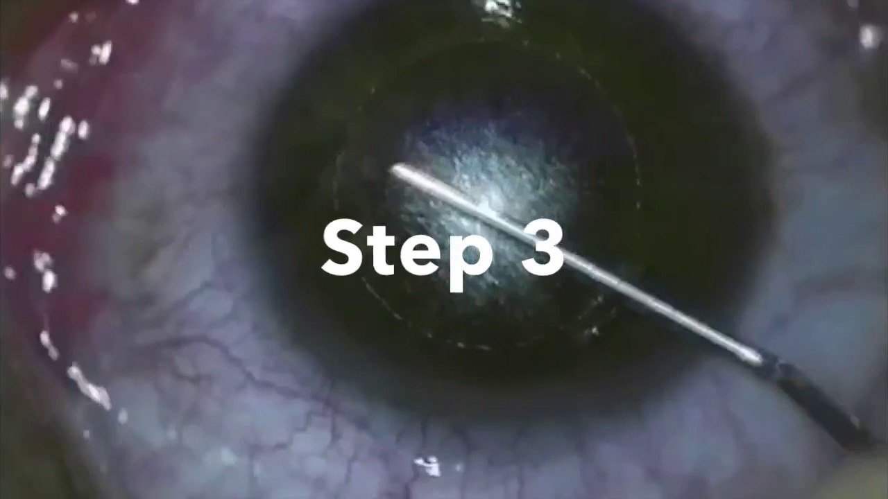 6 step intrastromal procedure for myopic treatment - YouTube