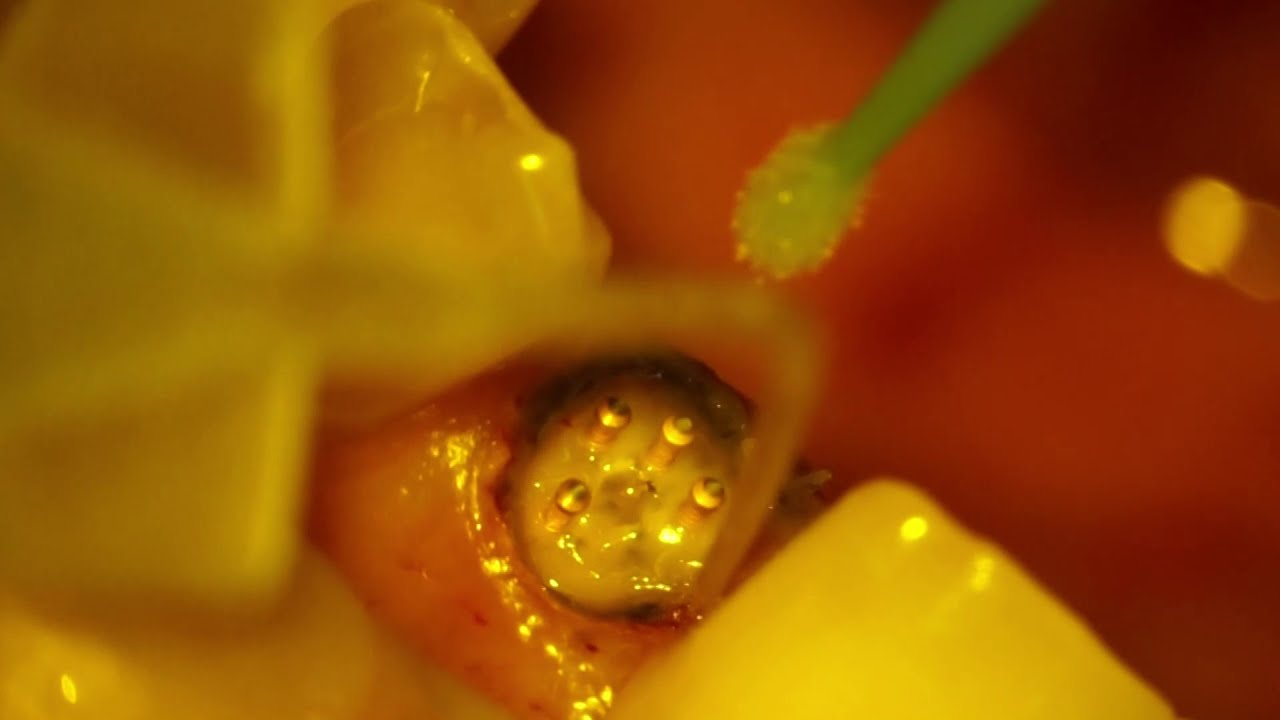 Dental Post and Crown of Anterior Tooth - YouTube