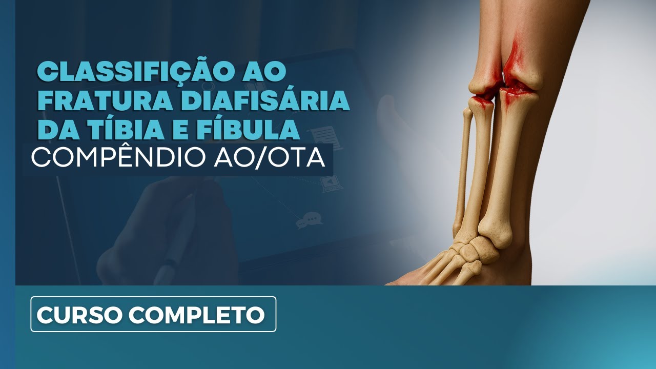 Classificação das Fraturas Diafisárias da Tíbia e Fíbula – Curso AO ...