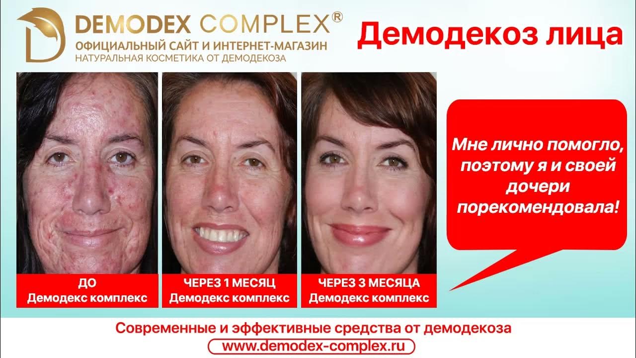 Демодекоз лечение. Препараты Демодекс Комплекс. Отзыв. Схема лечения ...