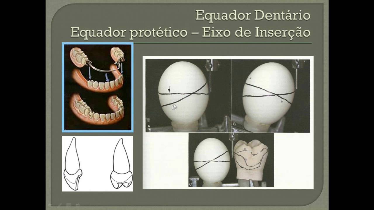 😉 ELEMENTOS DE PRÓTESE PARCIAL REMOVÍVEL : INTRODUÇÃO👌 - YouTube
