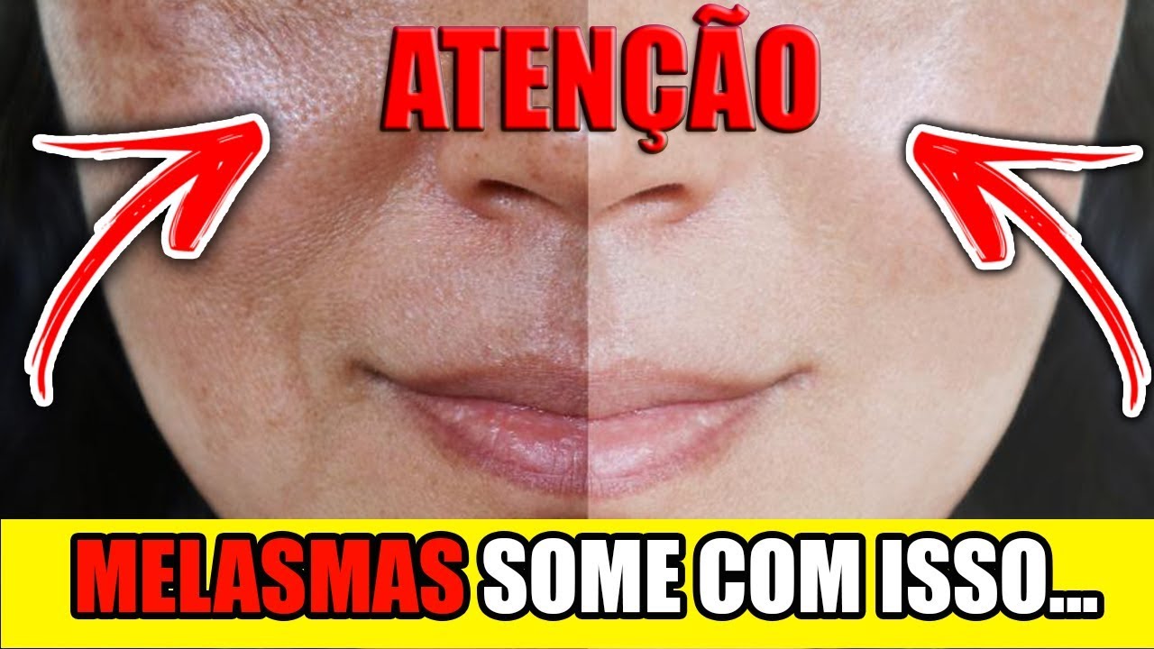 Melasmas No Rosto: Melasmas Como Tratar ? Como Tirar Melasmas Do Rosto ...