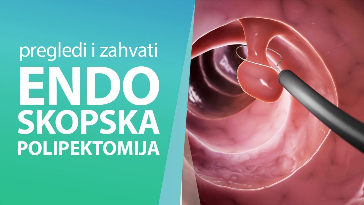 Poliklinika Amruševa: Endoskopska polipektomija - YouTube