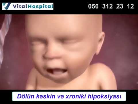 Dölün hipoksiyası (oksigen çatışmazlığı). 050-312-23-12 Vital Hospital