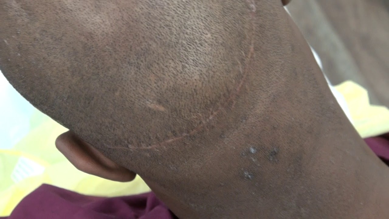 Black FUT Linear Scar Hair Transplant http://www.mhtaclinic.com - YouTube