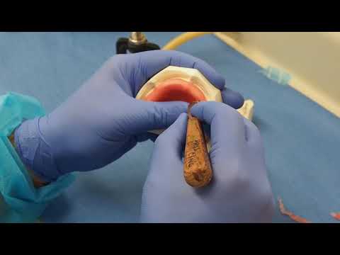 Impression trays 3 Wax relieve