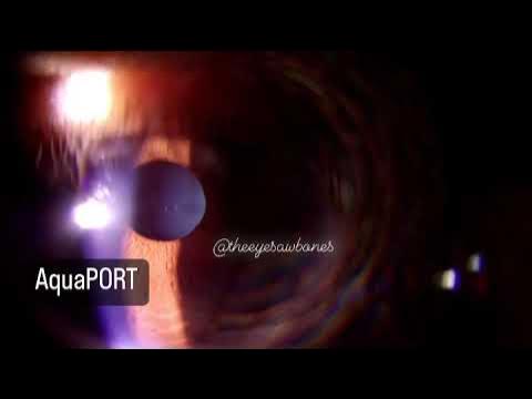 AquaPORT - Central hole in ICL - YouTube