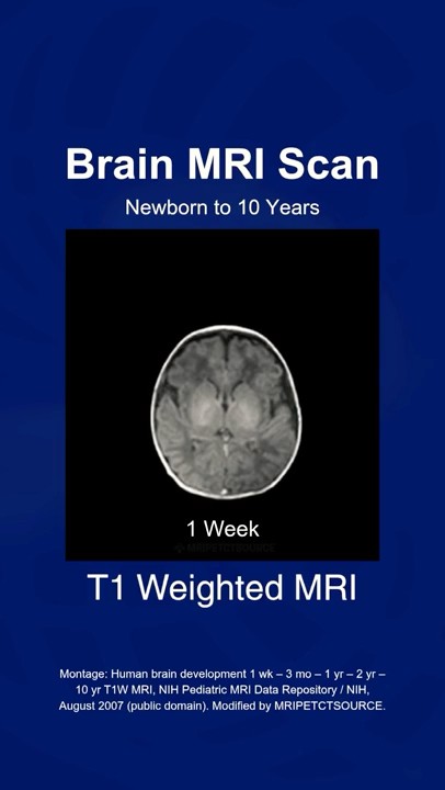 Watch Wrinkles Develop in Brain MRI Scans (T1 Weighted) - YouTube