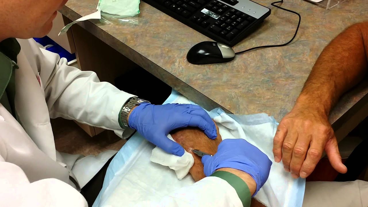 Broken hand surgical pins removed. - YouTube