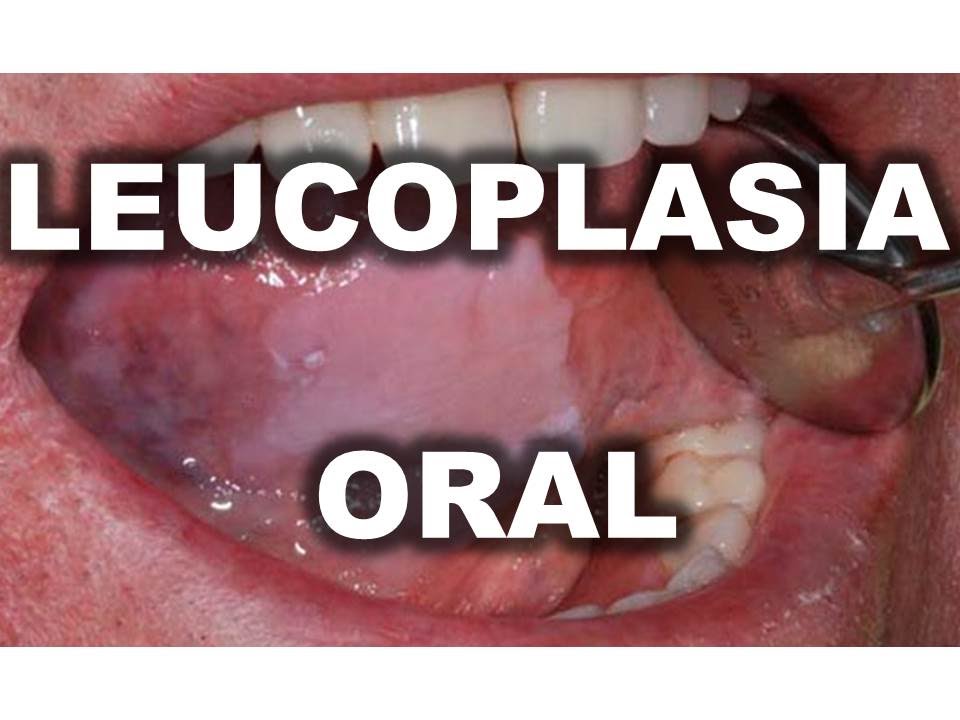 LEUCOPLASIA ORAL - PARCHES EN LENGUA, BOCA Y CARA INTERNA DE LAS ...