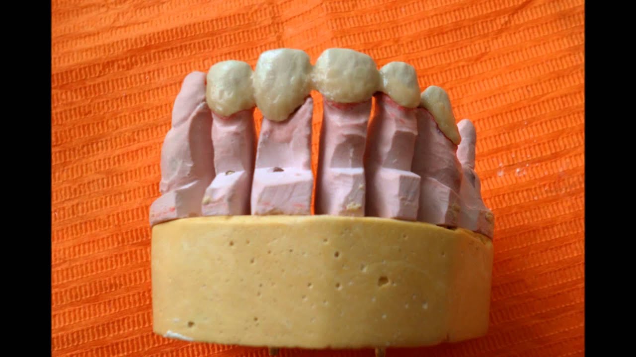 Proceso guiado de puente metal porcelana Laboratorio Armonía Dental ...